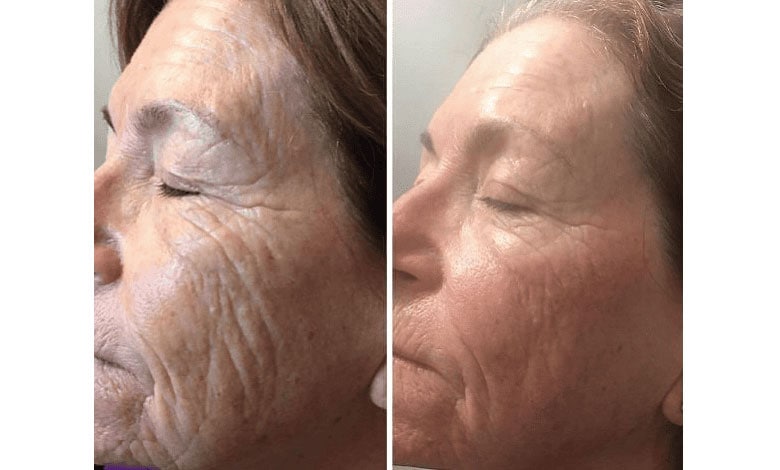 پلاژن تراپی چیست و چه کاربردی برای پوست دارد؟